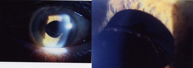 Medicine Decoded: Various Lines in Ophthalmology